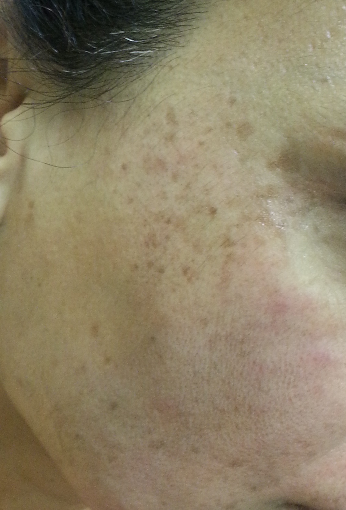 Pigmentation, Discoloration, Spot - Lily Dermal Care